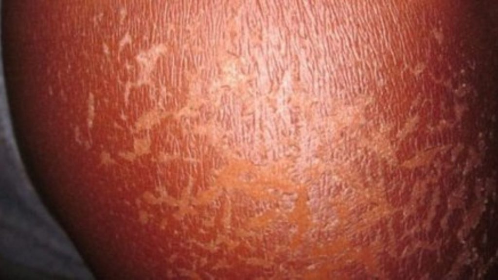 Sunburn On Black Skin - Causes, Signs, Treatment