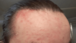 How To Treat Scalp Eczema - Causes, Symptoms, Remedy