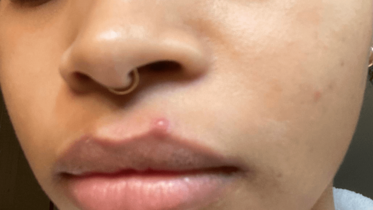 How To Get Rid Of Lip Pimples - Symptoms, Causes, Remedy